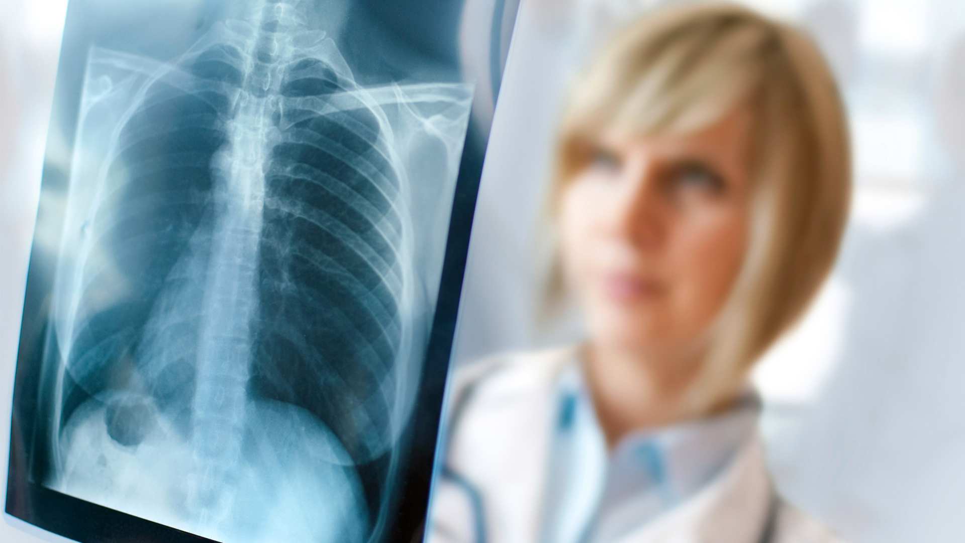 Pneumonia: saiba como prevenir e tratar a doença - Conceito Home Care